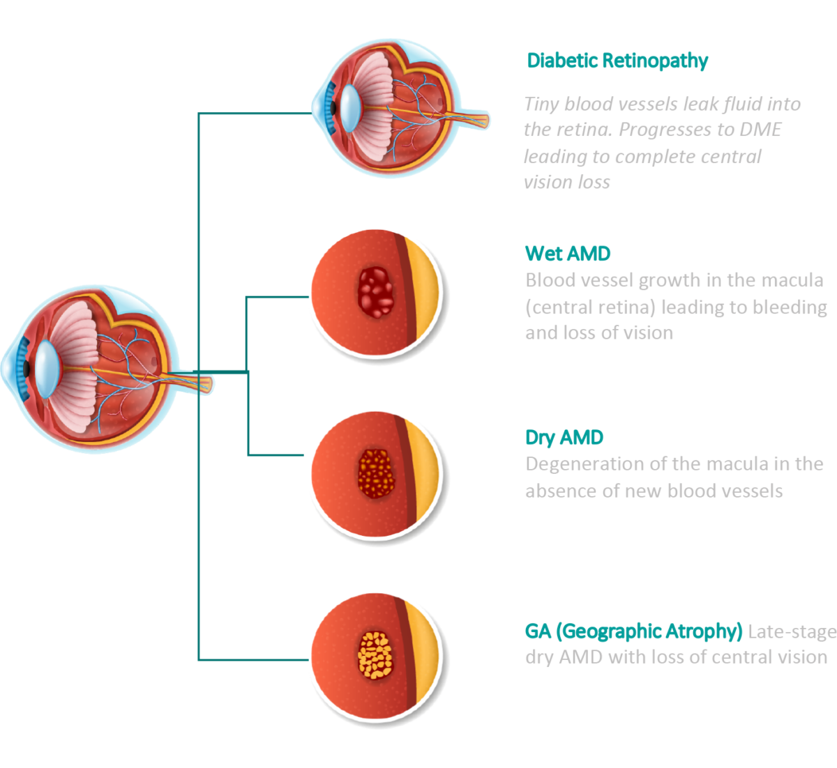 Preventing Retinal blindness - Eye Co Retina Therapeutics